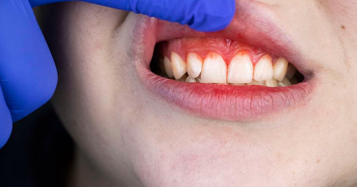 Doença na Gengiva Pode Causar Pneumonia Diabete e Demência